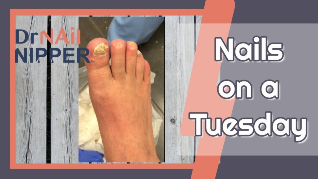 Nails on Callus Tuesday (2020) - Dr Nail Nipper