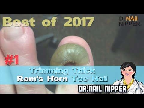 Rams Horn Nail [#1 Best of 2017] - Trimming Thick Ram's Horn Toe Nail ...