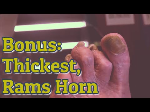 Weekend Bonus 👉Try Again👈🏿 Thickest Toenails and Bonus Rams Horn ...