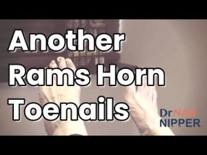 Throwback - Thick Toenails and Another Ram's Horn Nail - Dr Nail Nipper