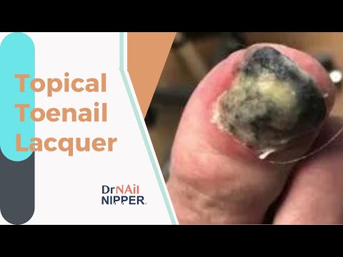 Patient used topical toenail lacquer. Callus Tuesday on a Wednesday ...